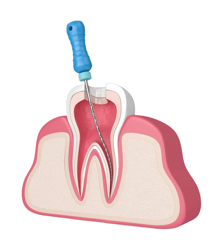 Painless Root Canal Treatment in Delhi | Clove Dental